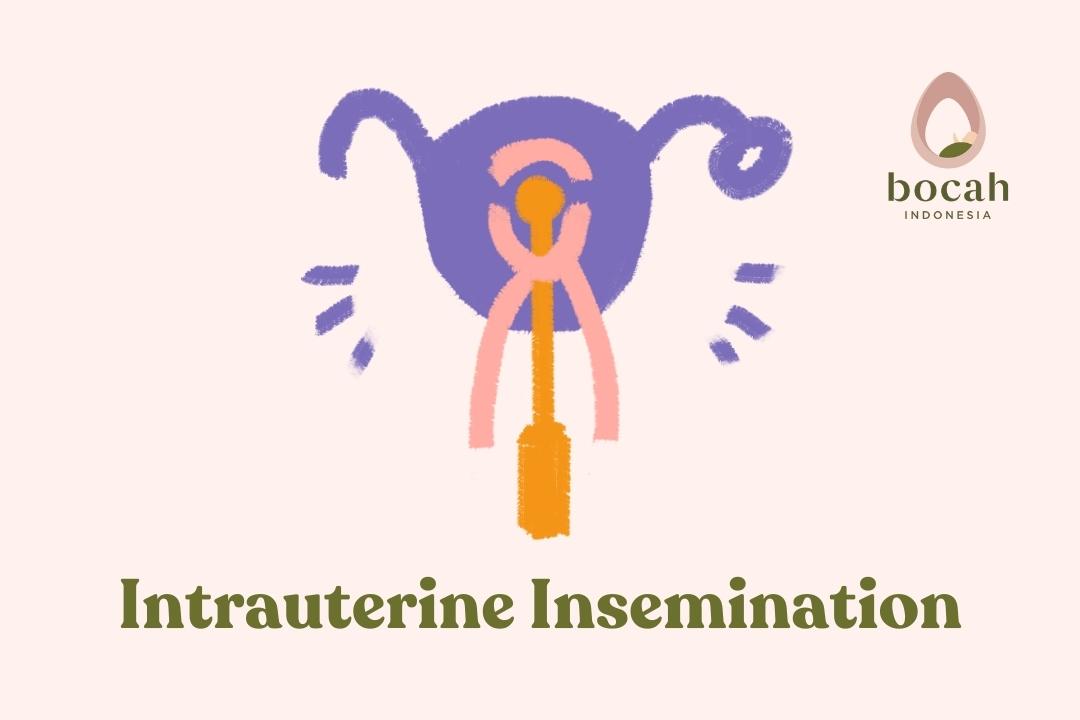 Inseminasi Buatan (IUI) - Metode Perawatan & Prosedur