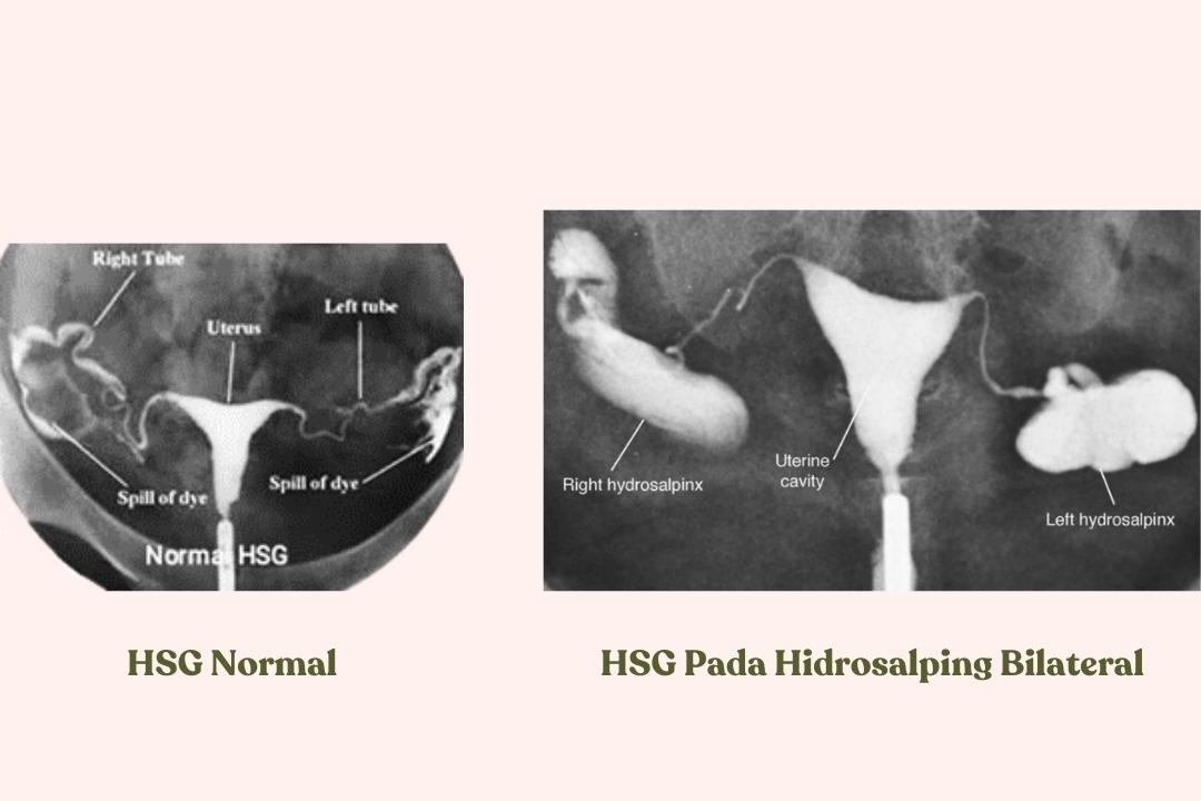 Hidrosalping, Penyebab Susah Hamil Pada Wanita