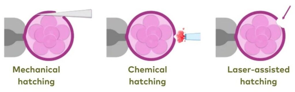 Assisted Hatching : Penjelasan, Tujuan, Prosedur, Metode