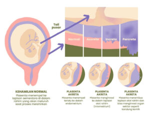 Plasenta Akreta, Saat Ari-Ari Tumbuh Terlalu Dalam