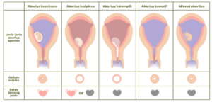Abortus Inkomplit: Ketika Keguguran “Bersisa”